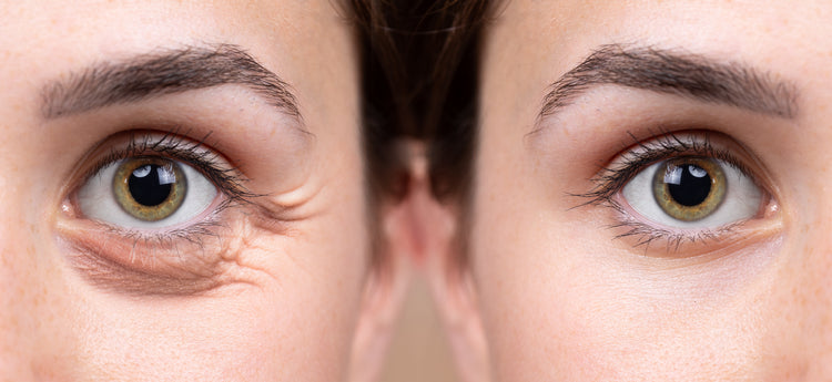 Behandeling wallen en kringen rondom ogen | YourSkinTherapist